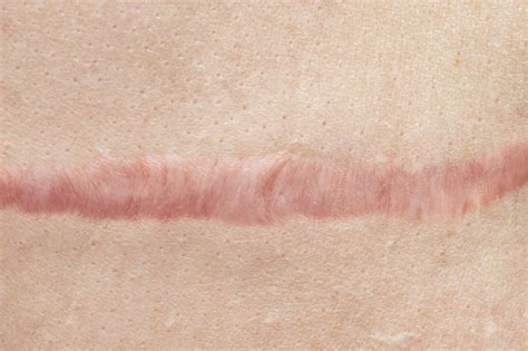 How to Reduce and Lighten Scars, According to Aesthetic Experts ...