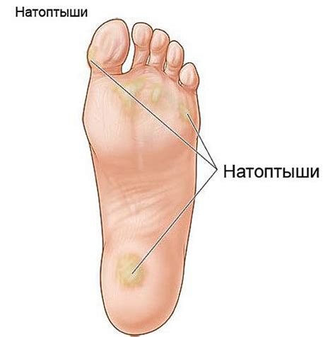 Как можно избавиться от натоптышей на пальцах ног