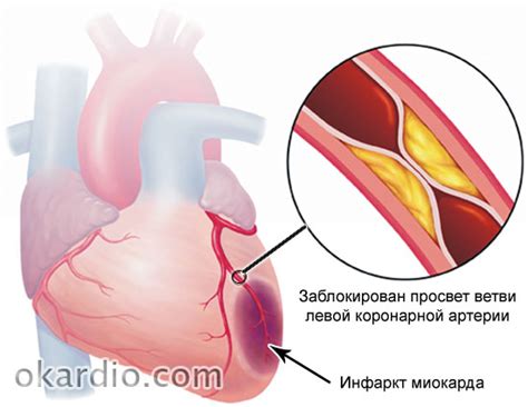 Бисопролол: от чего помогает, какие устраняет симптомы