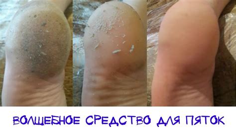 Силиконовые носочки для лечения трещин на пятках, чем лечить в домашних ...