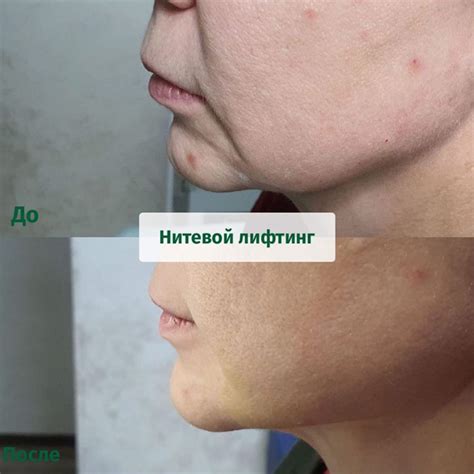 Нитевой лифтинг ⋆ Beauty Science ⋆ Саратов ⋆ Beauty Science