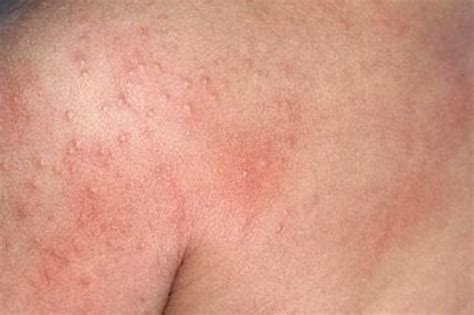 Is this prickly heat? - Emdoc Health
