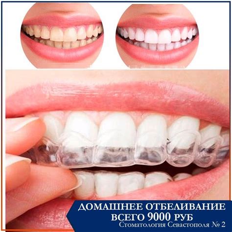 Домашнее отбеливание зубов с капами системы Opalescence: что это такое ...