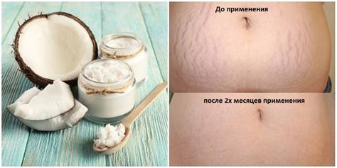 Как избавиться от растяжек на теле: убираем старые и новые стрии