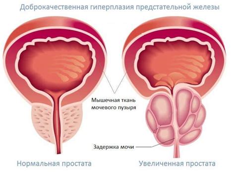 Аденома простаты | СевКлиник - медицинский центр| Севастополь