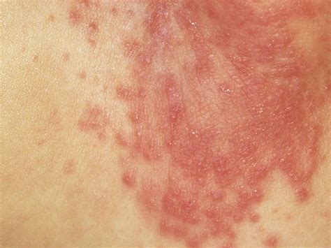 Diaper rash quiz - BabyCenter Canada