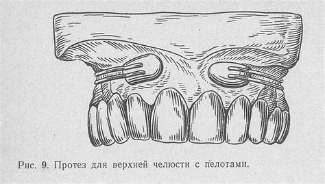 Пелоты ортопедические в стоматологии - это что, устройство, изготовление