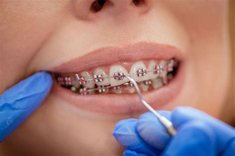 Orthodontic Care: What You Need to Know