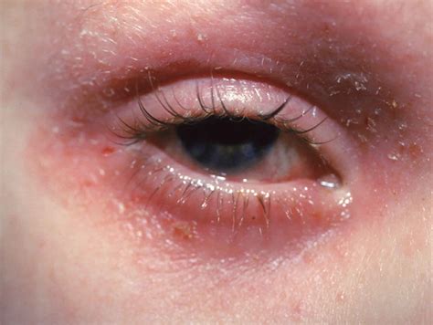 Eyelid Dermatitis (Eczema): Symptoms, Causes, And Treatment, 59% OFF
