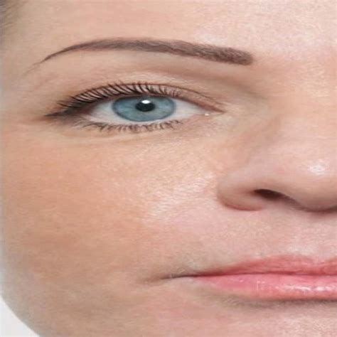 Neauvia Hydro Deluxe Skin Booster KL | Plump & Hydrate | Nexus Clinic