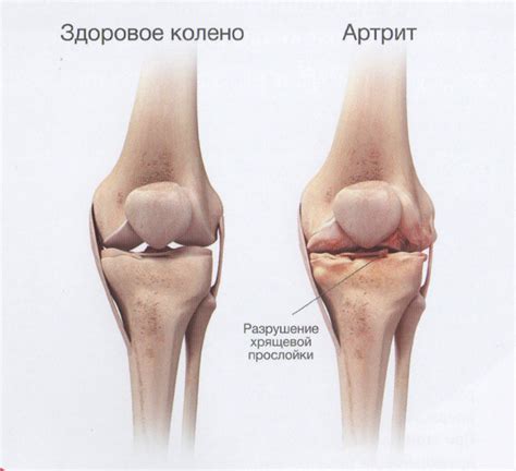 Эффективные упражнения для коленных суставов и связок