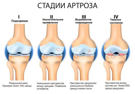 Информация к размышлению: артроз это лечение что за болезнь причины ...