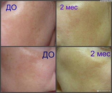 Отбеливание зоны бикини. рейтинг кремов и рецептов