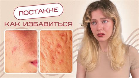 Как избавиться от постакне на лице в домашних условиях. Рецепты ...