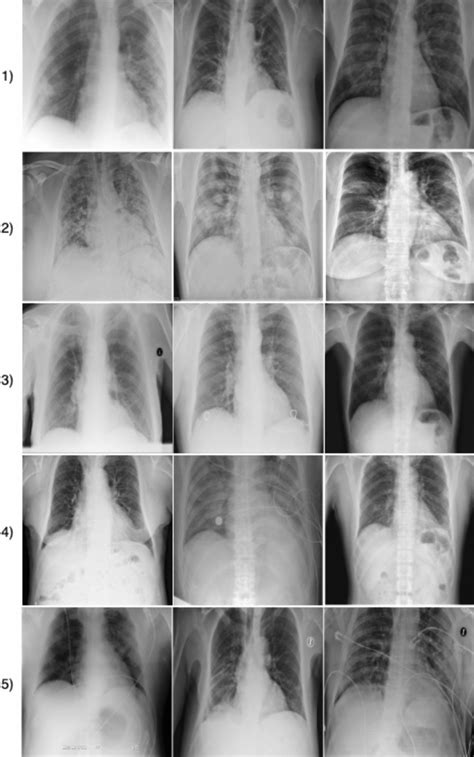 COVID-Net: a tailored deep convolutional neural network design for ...
