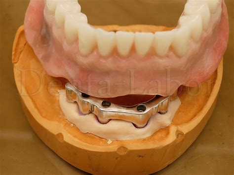Съёмный, частично съёмный зубной протез на нижнюю челюсть – Denta-Labor