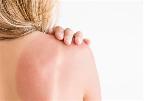 Солнечные ожоги – типы ожогов, опасности, профилактика. | MedAboutMe