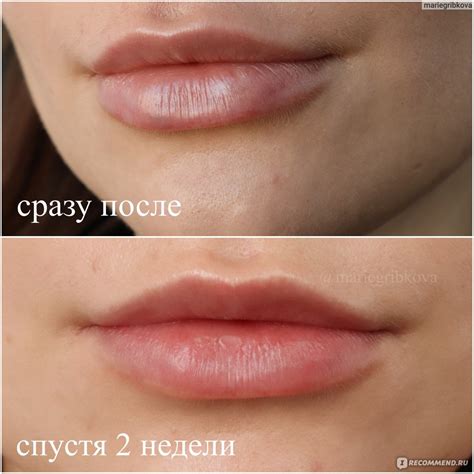 Филлер для губ Juvederm Ultra Smile - «Заезженный Juvederm Ultra Smile ...