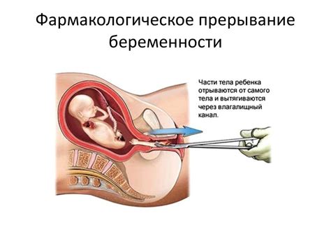 Методы искусственного прерывания беременности в ранние и поздние сроки ...