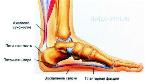 Признаки пяточной шпоры не заметить невозможно