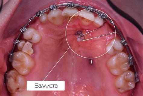 Как работают брекеты - Семейная стоматология - г. Химки