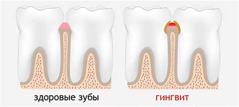 Лечение гингивита десен в Уфе, т. 8 (347) 299-64-64