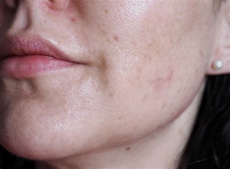 Review of New Online Dermatologist- Dermatica. The U.K. version of Curology