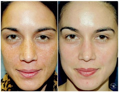 Chemical Peels for Atlanta & Alpharetta, GA - Swan Center for Plastic ...