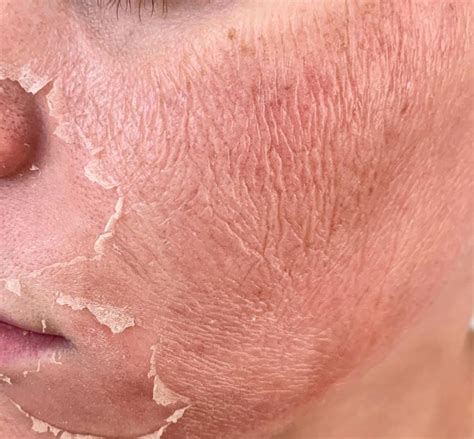 Chemical Peels Facial in Allen | Face Peeling Treatments | (972) 630-4257