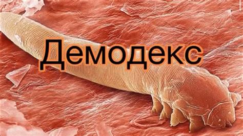 Демодекс - YouTube