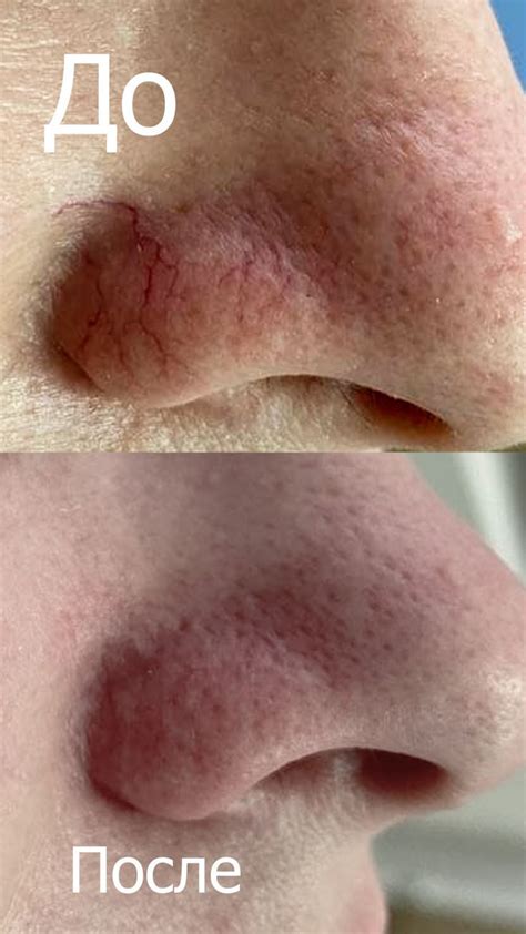 Как Избавиться От Сосудов На Носу in 2024 | Skin care, Photo and video ...