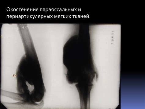 Рентгенологические синдромы заболеваний костей и суставов - презентация ...