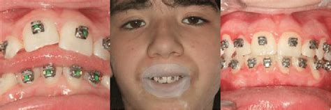 Result of 15 Mins per day with a froggy mouth. | Download Scientific ...