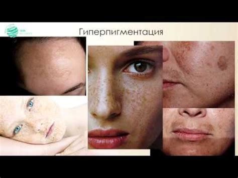 Срединный пилинг без побочных эффектов. Лечение угревой болезни ...