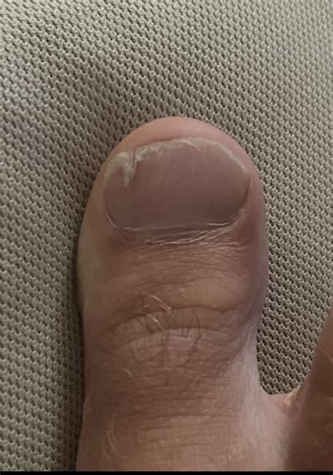 Best Fungal Nail Treatment UK (Top 6 best products) - You Well