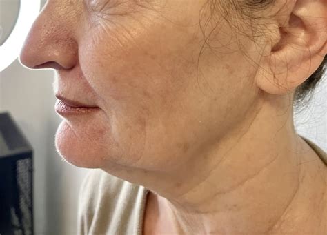Behandlinger | Bellis Cosmetic