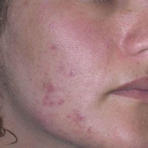 Phototherapy | BBL- Broadband Light | Raleigh, NC | Triangle Facial ...