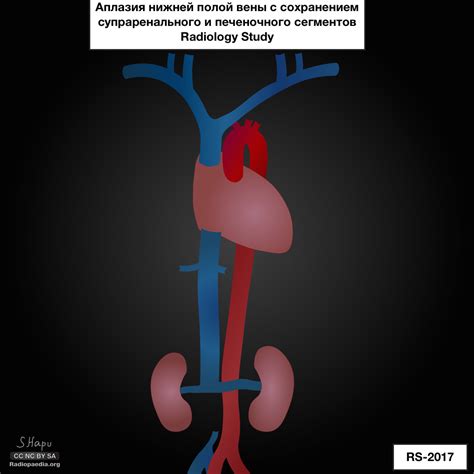 Аномалия постренального сегмента НПВ — 24Radiology.ru