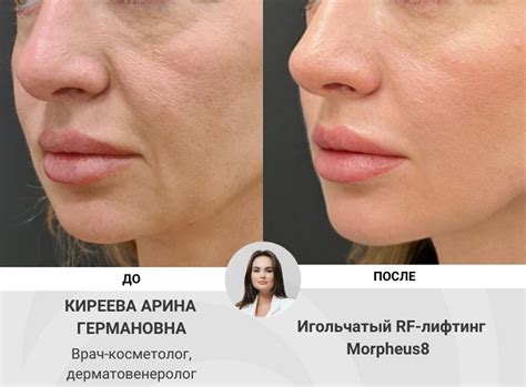 Игольчатый RF-лифтинг лица Morpheus8 в Москве: цены в клинике GMTClinic