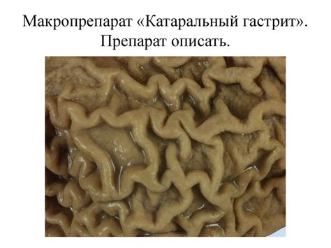 Острое воспаление. Морфологические проявления экссудативного воспаления ...