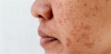 Sun-damaged Skin Treatments | Mesa, AZ | Sagebrush Dermatology