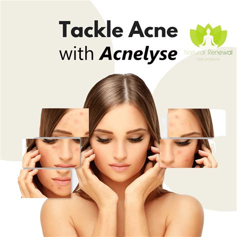ACNELYSE Cream: Acne, Anti-Aging & Skin Renewal – The Natural Renewal
