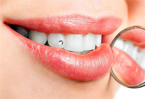 Стразы на зубах | DENTAL-INFO