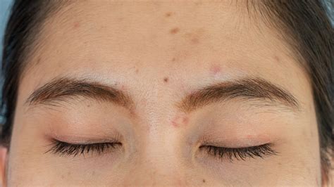 What's Causing Acne Between Your Eyebrows And How Do You Get Rid Of It?