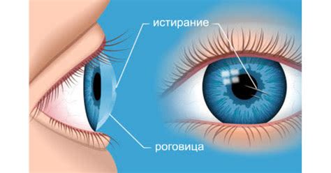 Повреждение роговицы глаза: ощущение песка в глазах, капли при травме ...