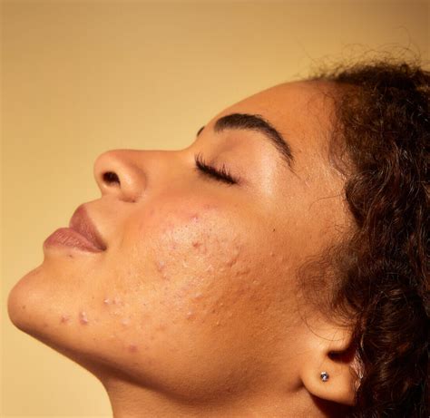 Acne Clear Formula | PureHealth Research