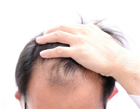 Effective Hair Loss Treatment | Dermacontour Ottawa