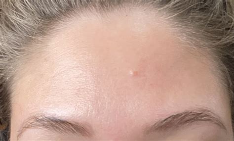 Frownie's Facial Patches Review — Life With Nikita