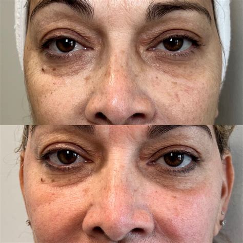 Deka Laser Patient 1 - Florida Lakes Spa