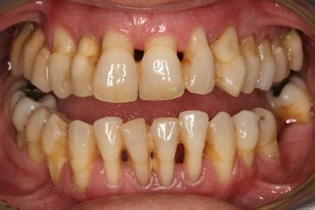Лечение Пародонтоза Киев ᐉ Стоматологическая Клиника Dental Art